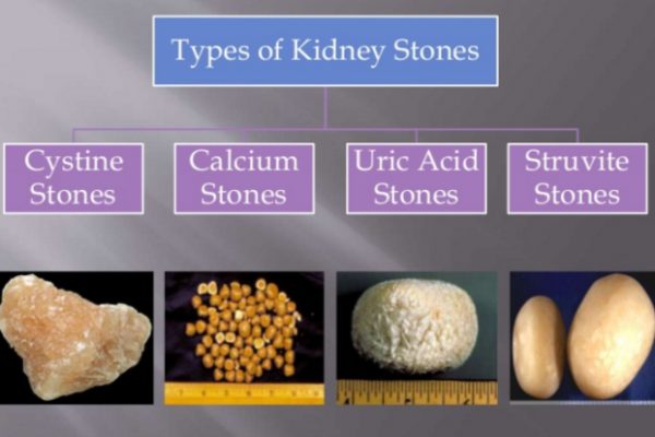 Types of Kidney Stones - Dr. Irfan Shaikh | Urolife Clinic, Pune