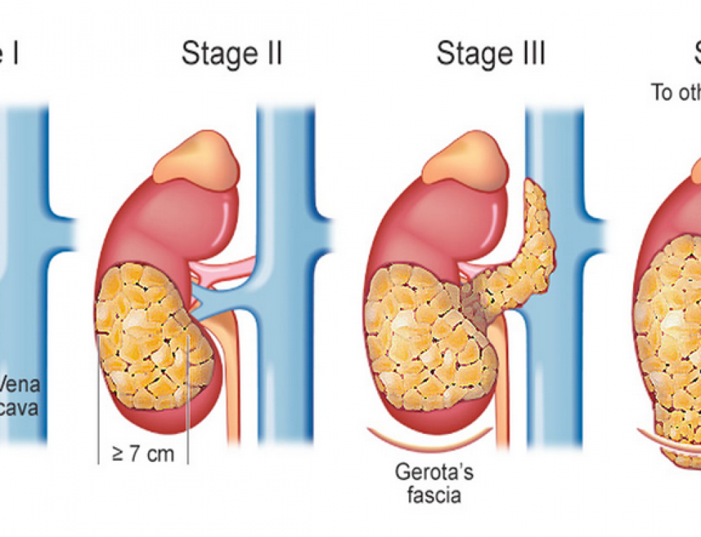 Types of Kidney Stones - Dr. Irfan Shaikh | Urolife Clinic, Pune