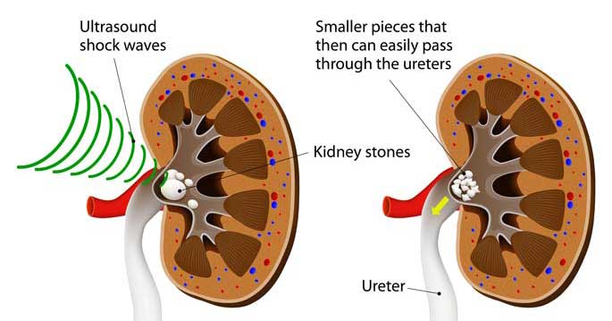 ESWL Surgery for Kidney Stone Removal in Pune | Urolife Clinic