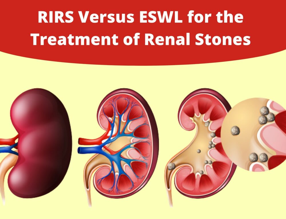 RIRS Surgery - Purpose, Procedure and Advantages - UroLife