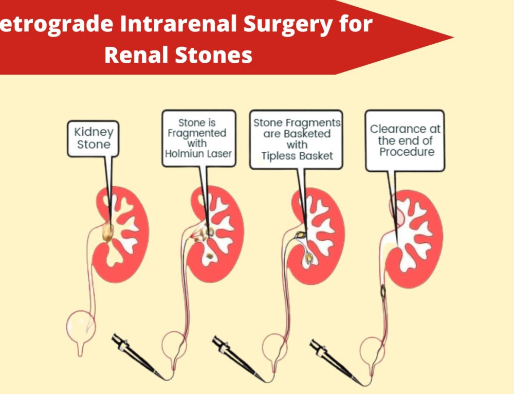 RIRS Surgery - Purpose, Procedure and Advantages - UroLife