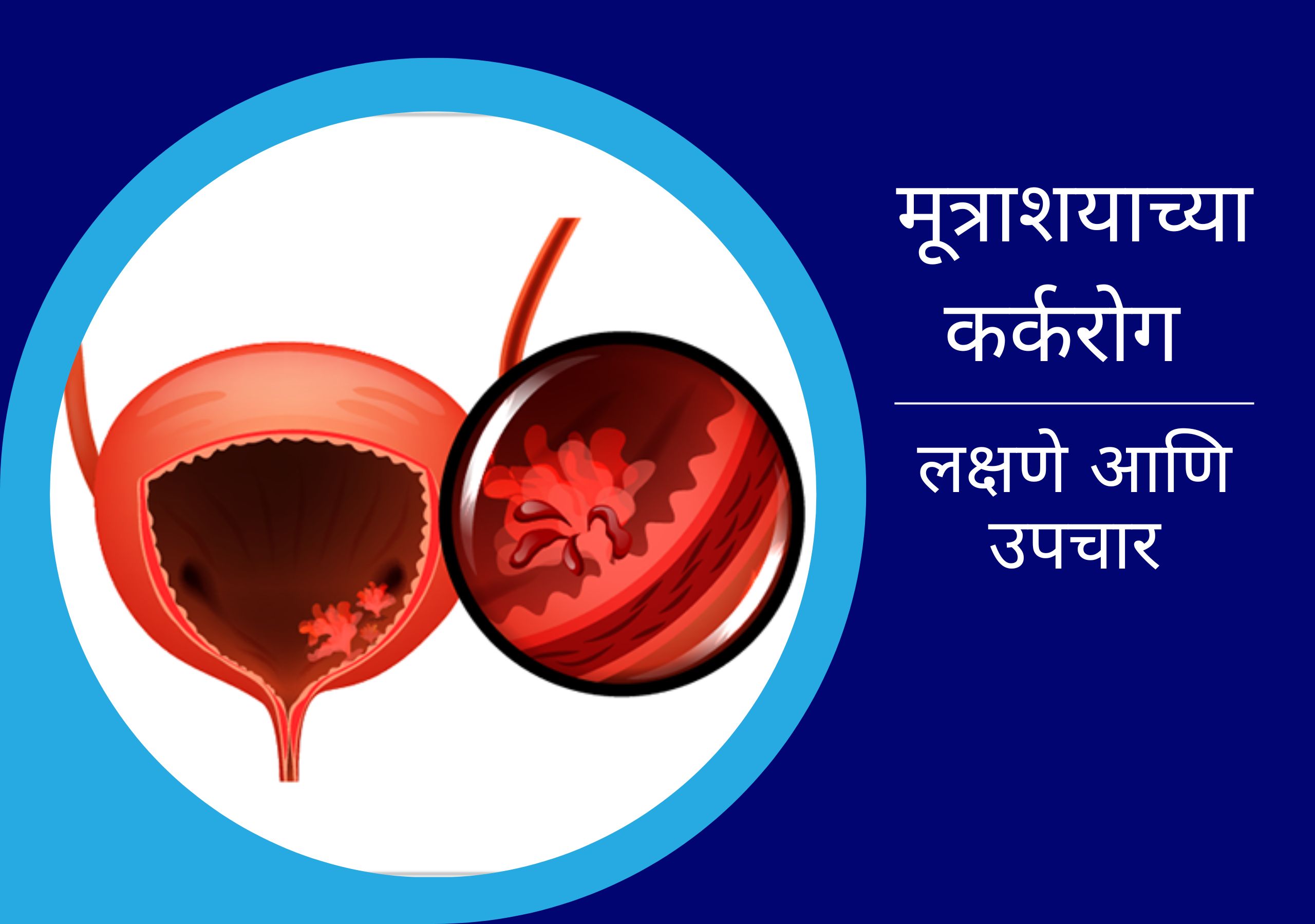 Bladder Cancer symptoms - UroLife