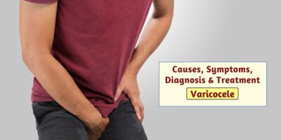 Varicocele - Causes, Symptoms, Diagnosis & Treatment - UroLife