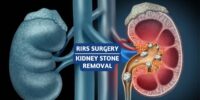RIRS Surgery - Purpose, Procedure and Advantages - UroLife