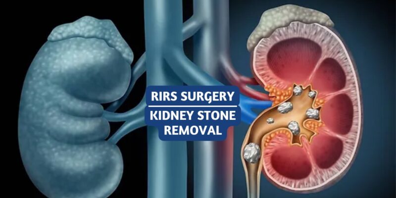 RIRS Surgery - Purpose, Procedure and Advantages - UroLife